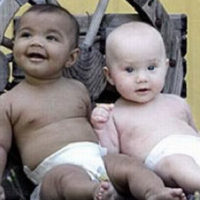 Top 10 Bizarre And Rare Types Of Twins - Listverse