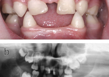 10 More Fascinatingly Rare Disorders - Listverse