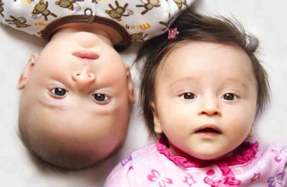 Top 10 Bizarre And Rare Types Of Twins - Listverse