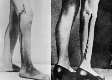 Top 10 Horrific Nazi Human Experiments - Listverse