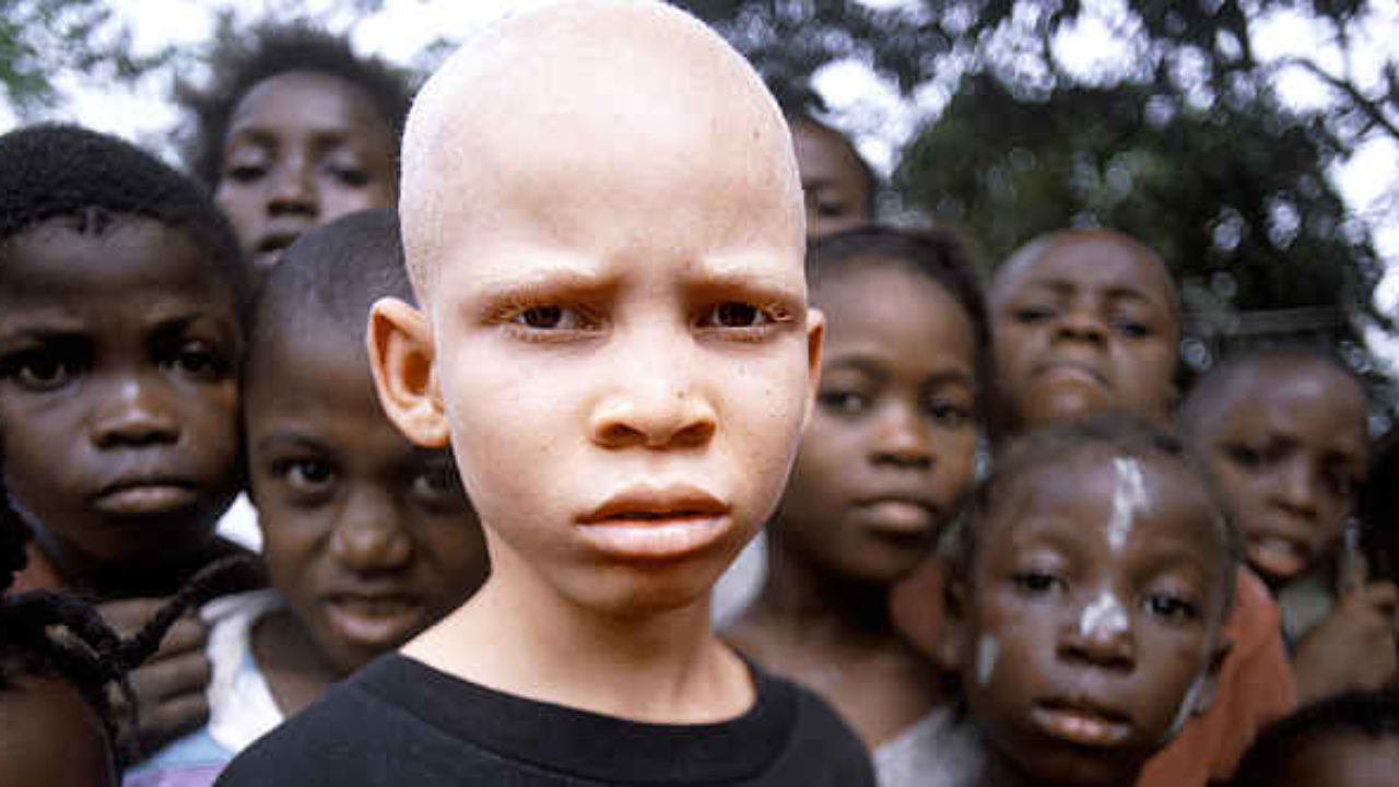 CAUCASOID White Skin means Albino Mutants with Leprosy = UN-CLEAN = DISEASE