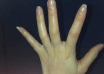 10 Tales Of Oddly Colored People - Listverse