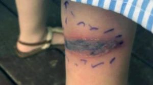 10 Deaths And Serious Injuries Caused By Spiders - Listverse