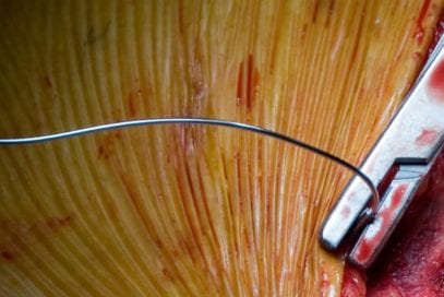 10 Troubling Items Left In Patients After Surgery - Listverse