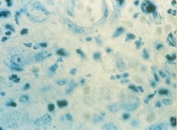 10 Nightmarish Flesh-Eating Pathogens That Consume Humans - Listverse
