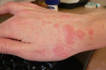 10 Insanely Scary Parasitizations Of The Human Body - Listverse